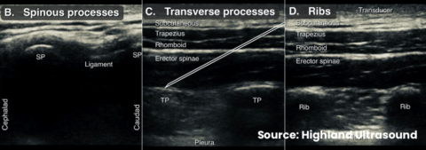 Erector Spinae | Nerve Block