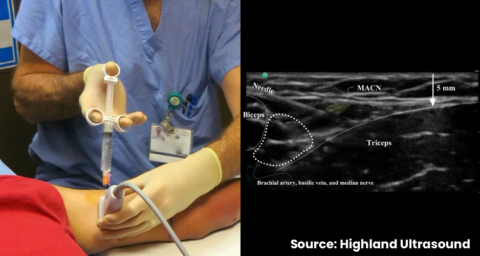 Medial Antebrachial Cutaneous | Nerve Block