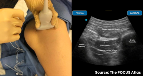Transgluteal Sciatic | Nerve Block